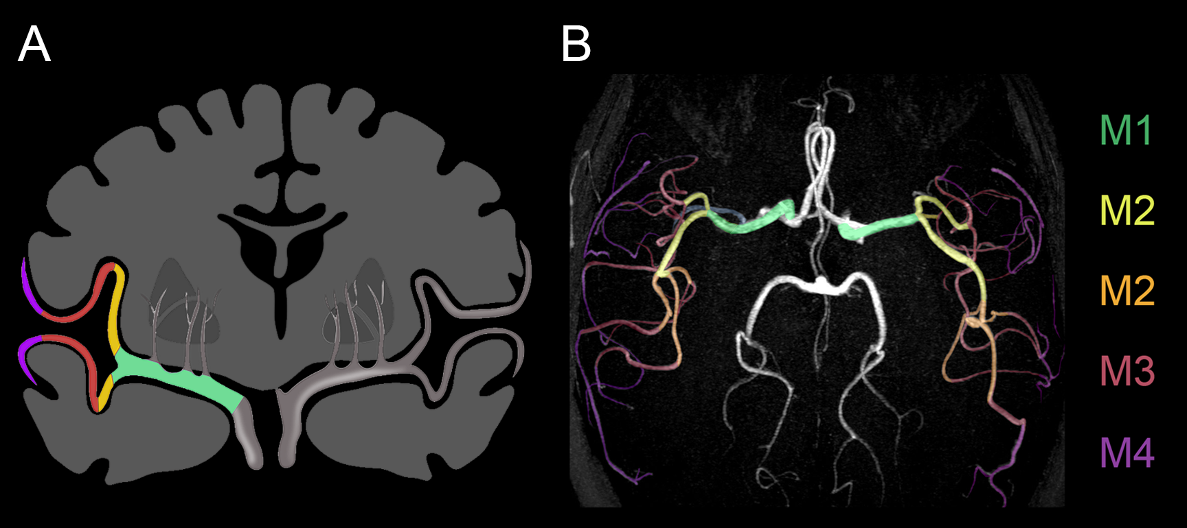 Théorie | Imagerie de l'AVC aigu