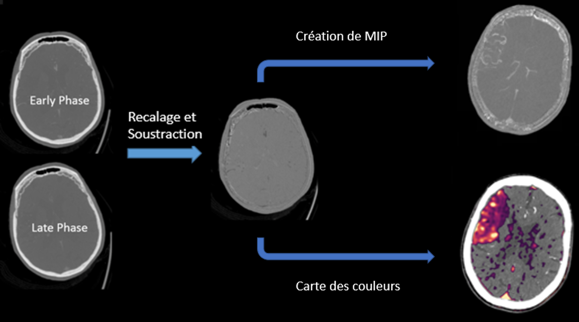 Théorie | Imagerie de l'AVC aigu